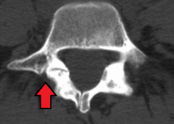 What Are the Main Types of Listhesis?
